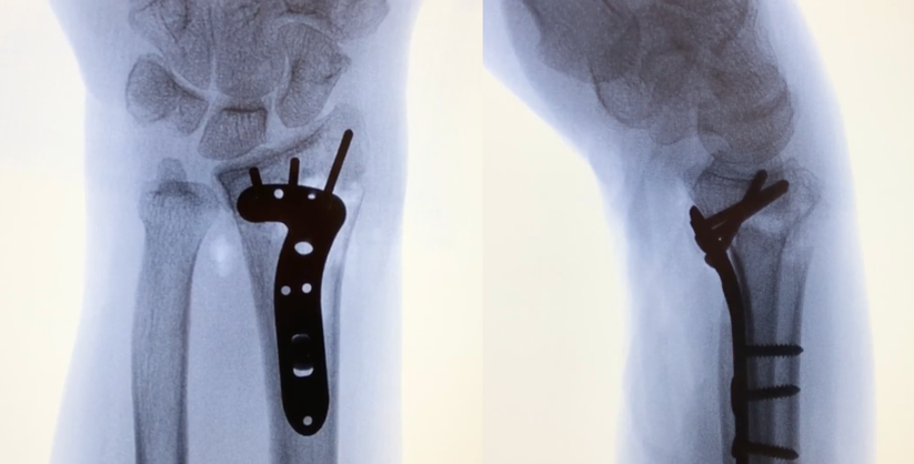 Volar Locking Plate Fixation Of Distal Radius Fractures Surgical